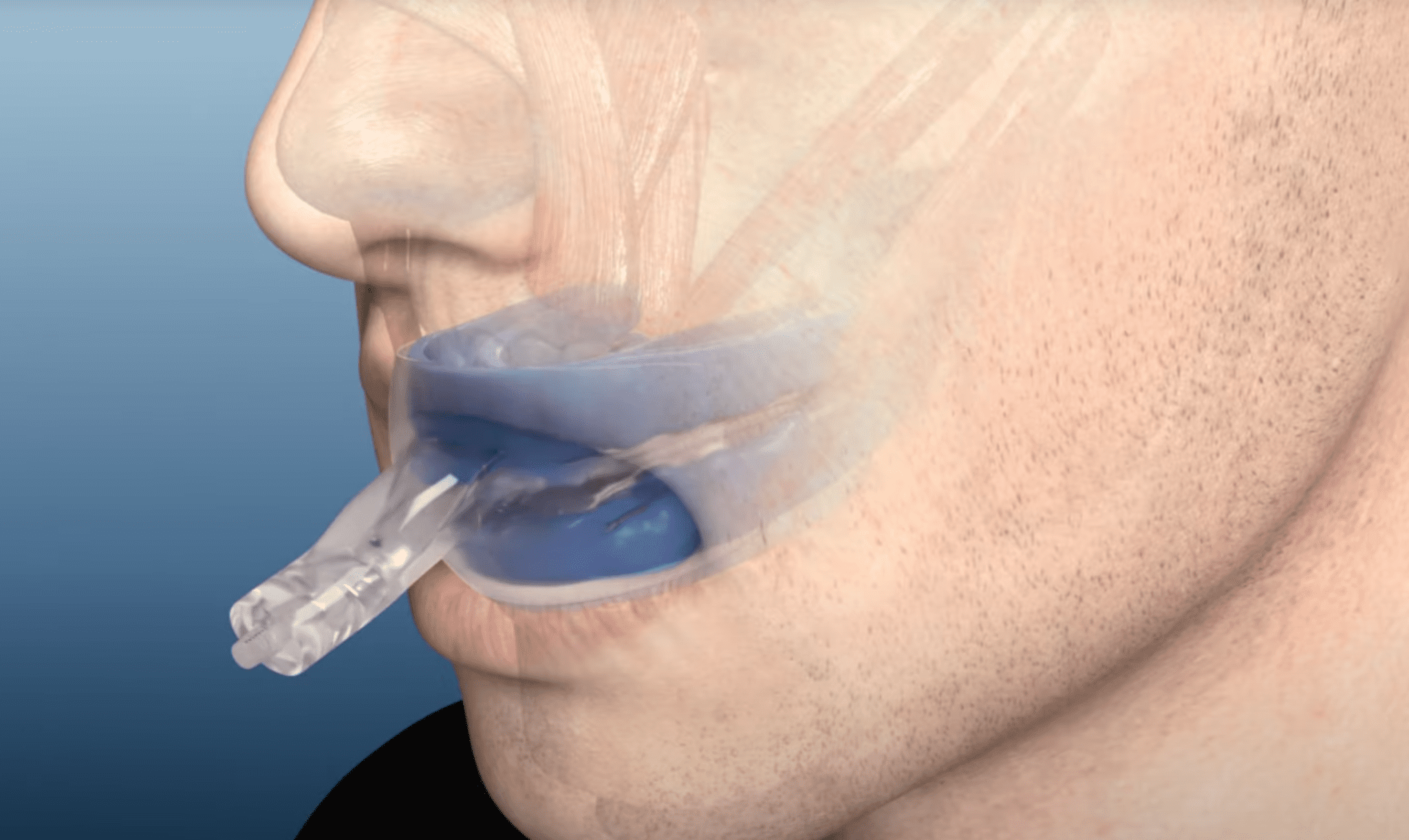 Types of Oral Appliances for Sleep Apnea | 2026 Guide